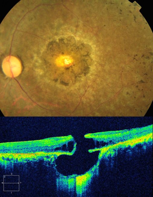 Winner of June 2021 – Vitreo Retina Society